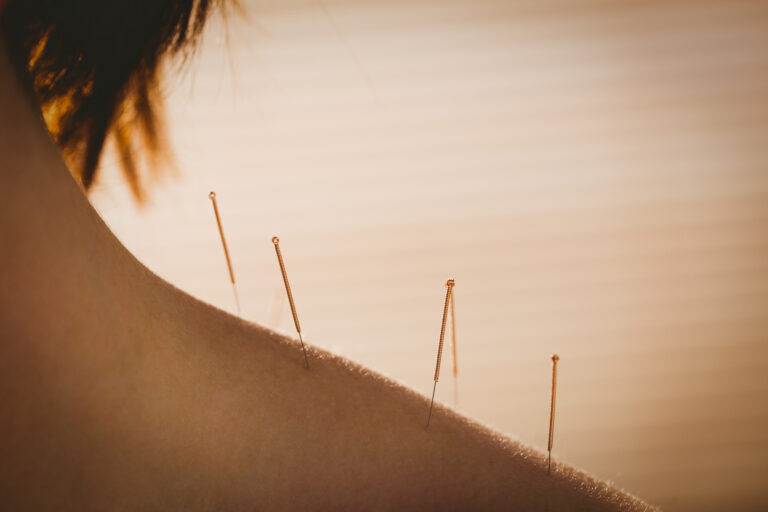 Acupuncture Calgary - CANSPORTS Wellness & Therapy